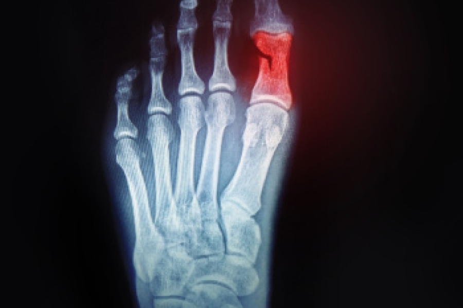 Facts About Broken Toes