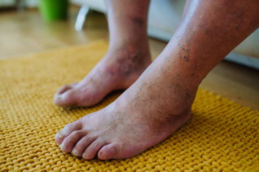 How Diabetes Can Affect Foot Health