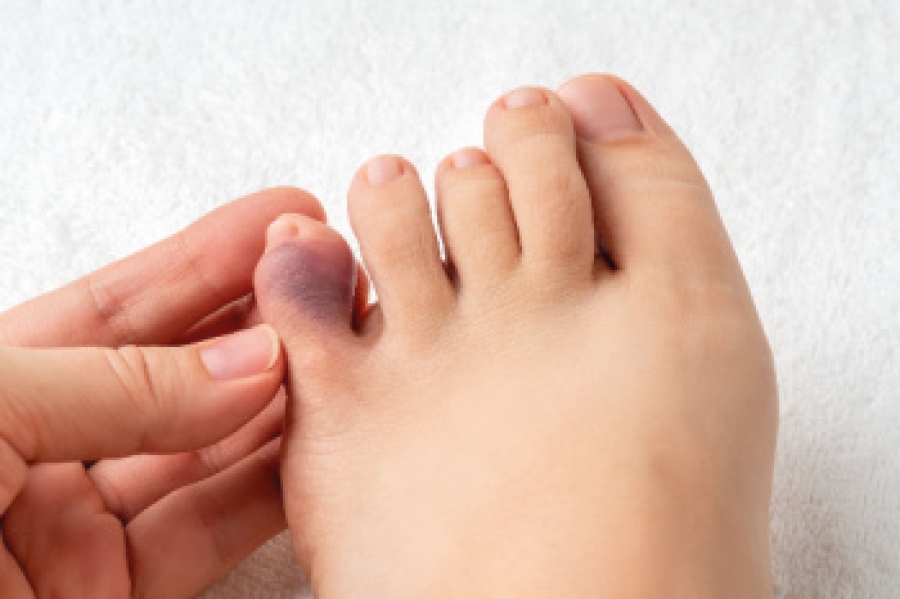 What Are the Symptoms of a Broken Pinky Toe?